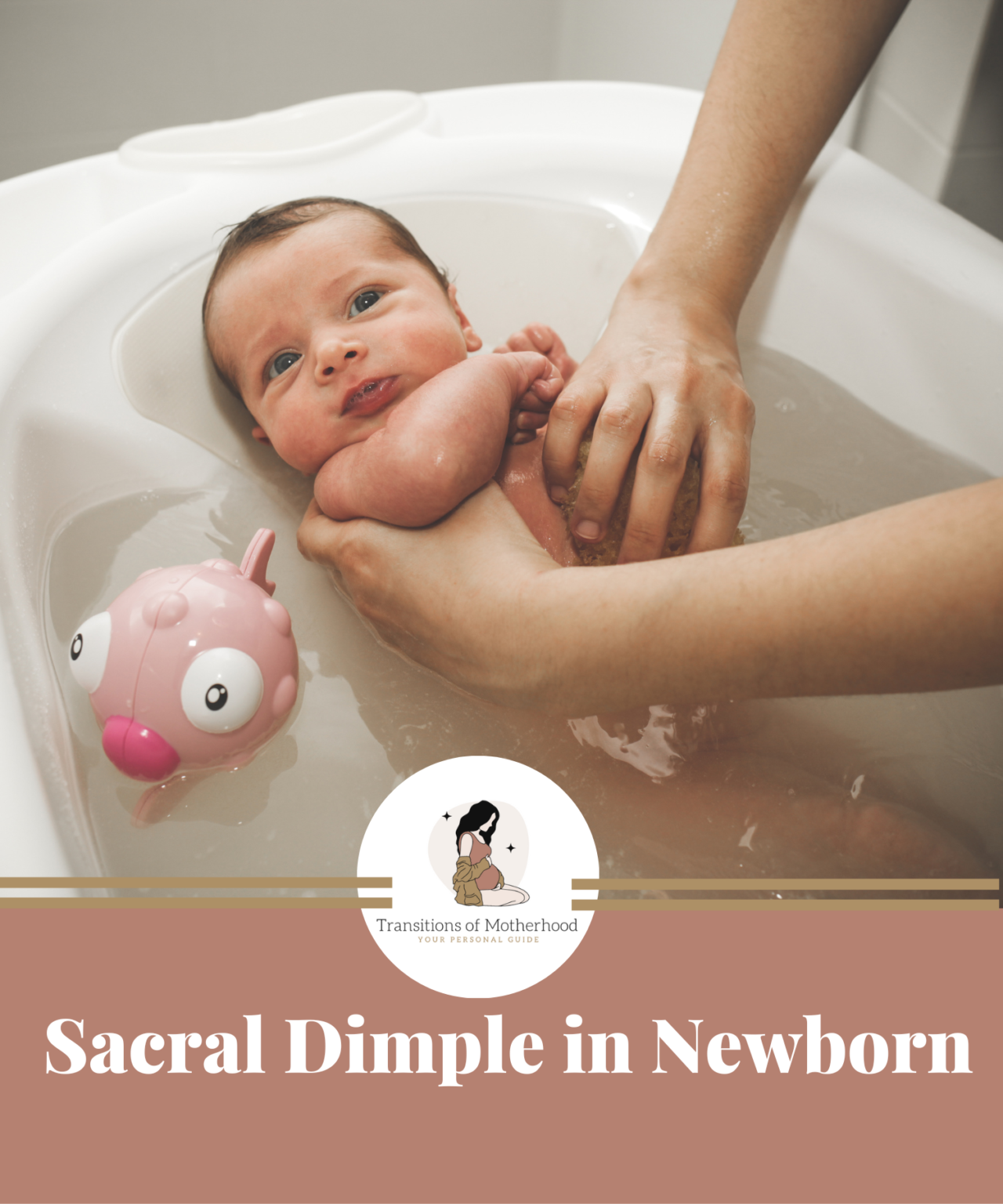 Sacral Dimple in Newborn: Harmless or Dangerous? - ToM